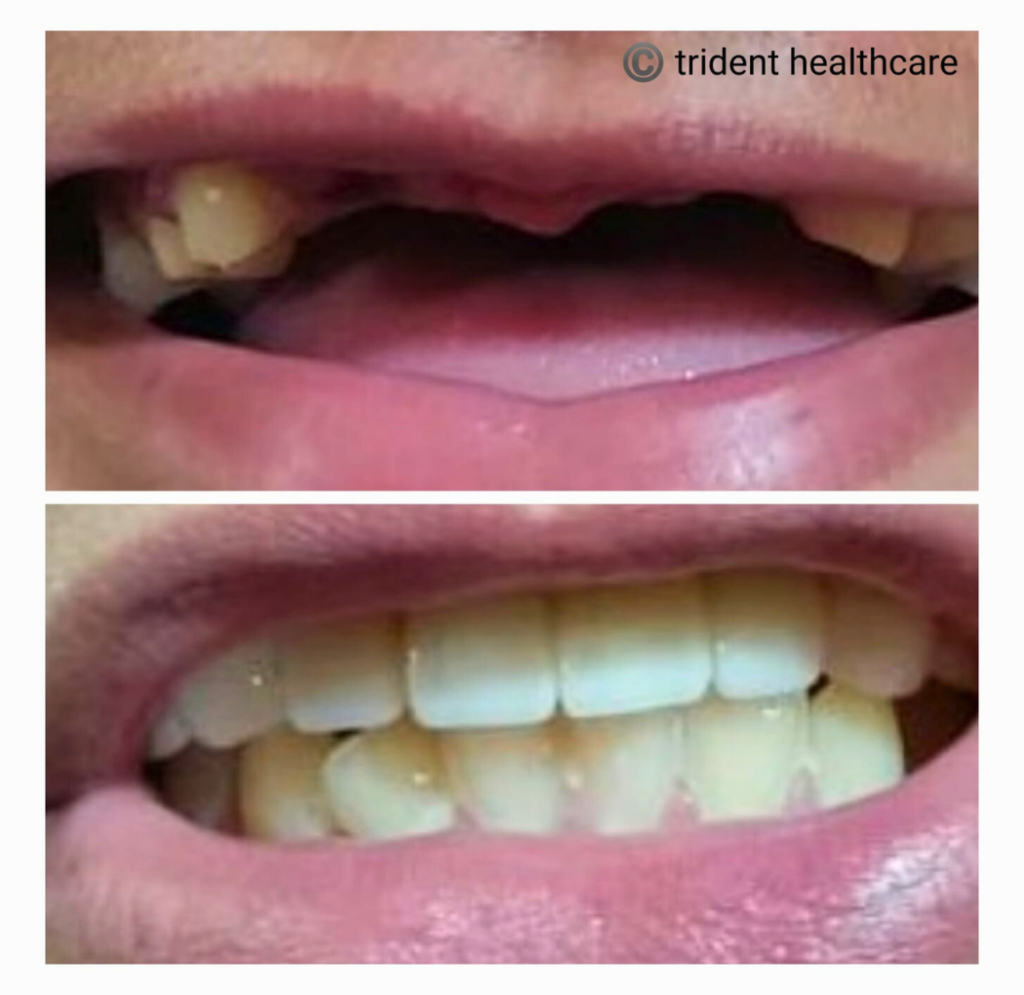 Tooth Scaling Services | tridenthealthcare.co
