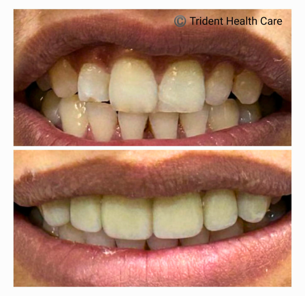 Tooth Scaling Services | tridenthealthcare.co