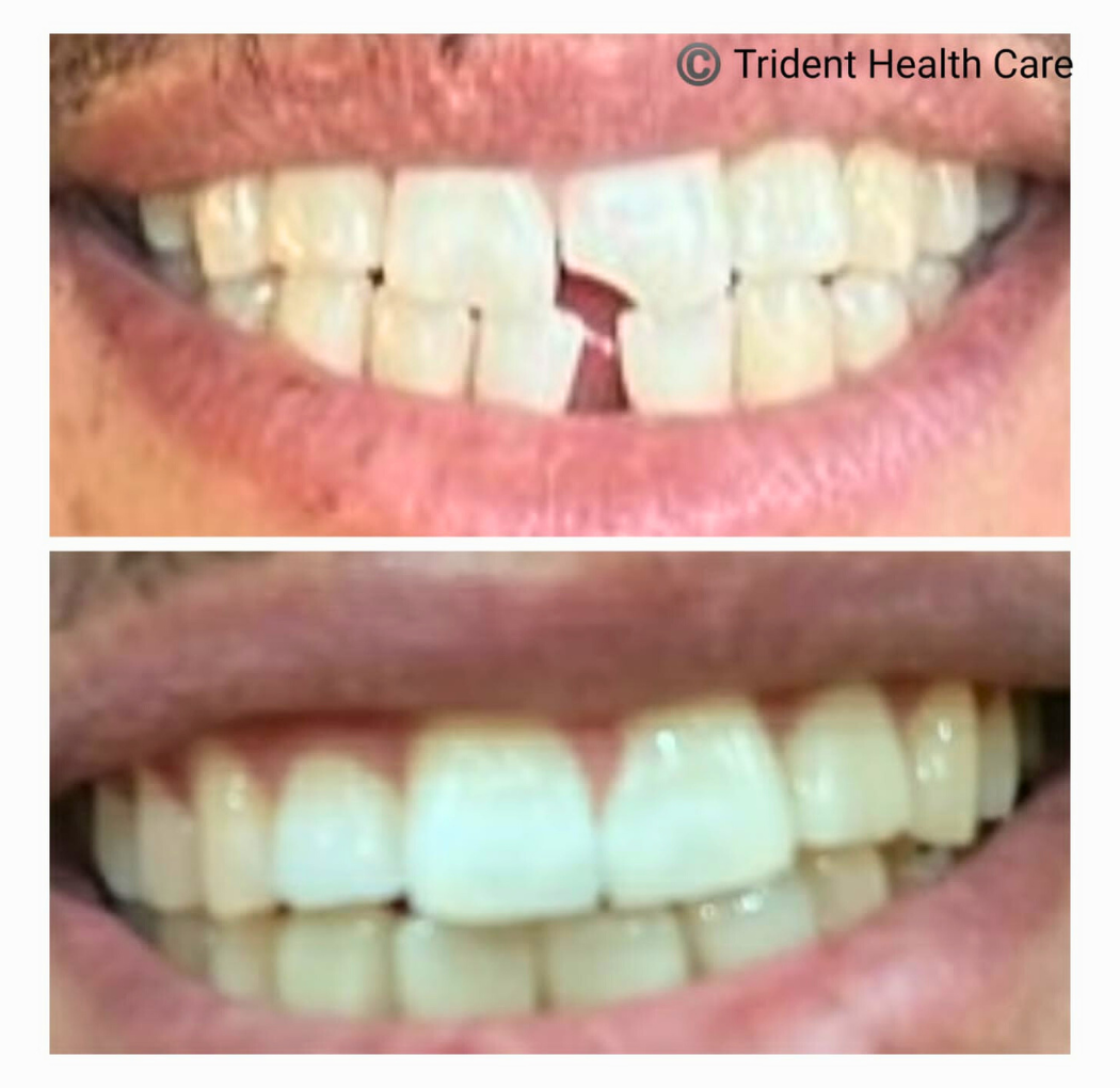 Advanced Gum Treatment Services | tridenthealthcare.co